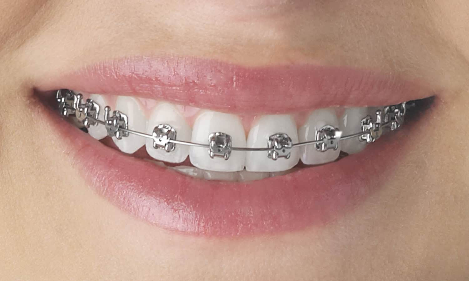American Orthodontics Brackets in Coeur D’Alene, ID
